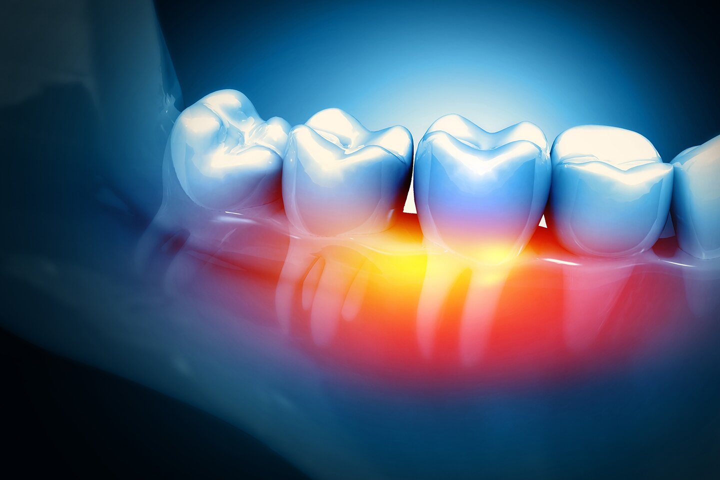 Paradentóza – jak předcházet krvácení dásní?